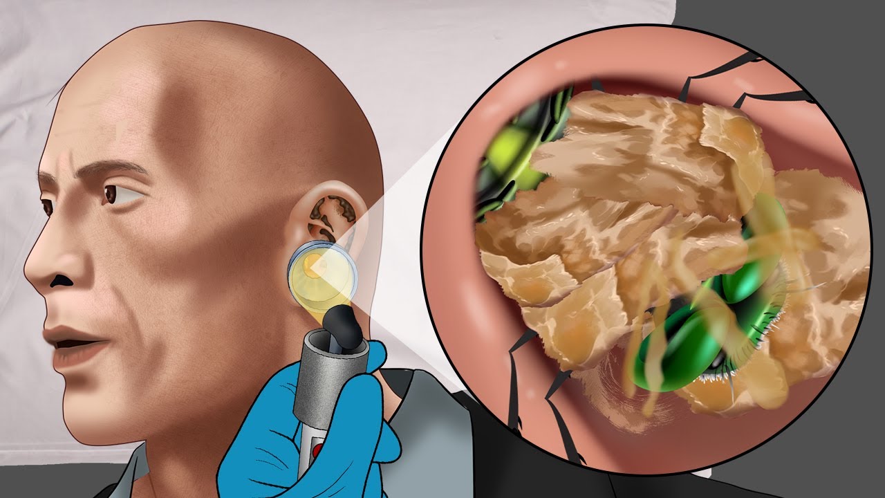 ASMR Animation Ear Cleaning and Ear Wax Removal - YouTube