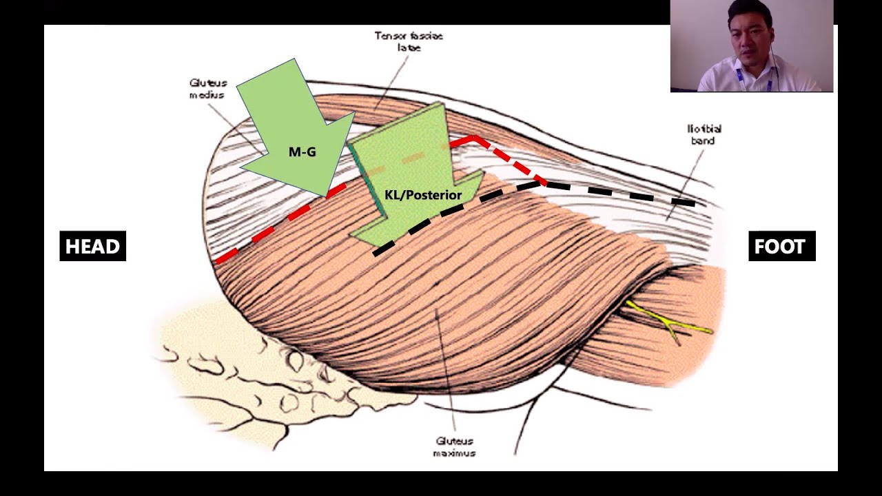 Modified Gibson Approach & Ganz Trochanteric Osteotomy - Mr Daud Chou ...