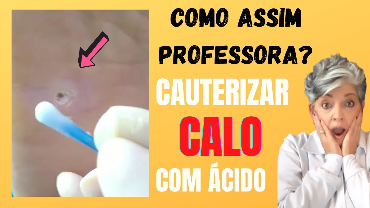 Cauterizar Calo com Ácido Como Assim Professora - YouTube