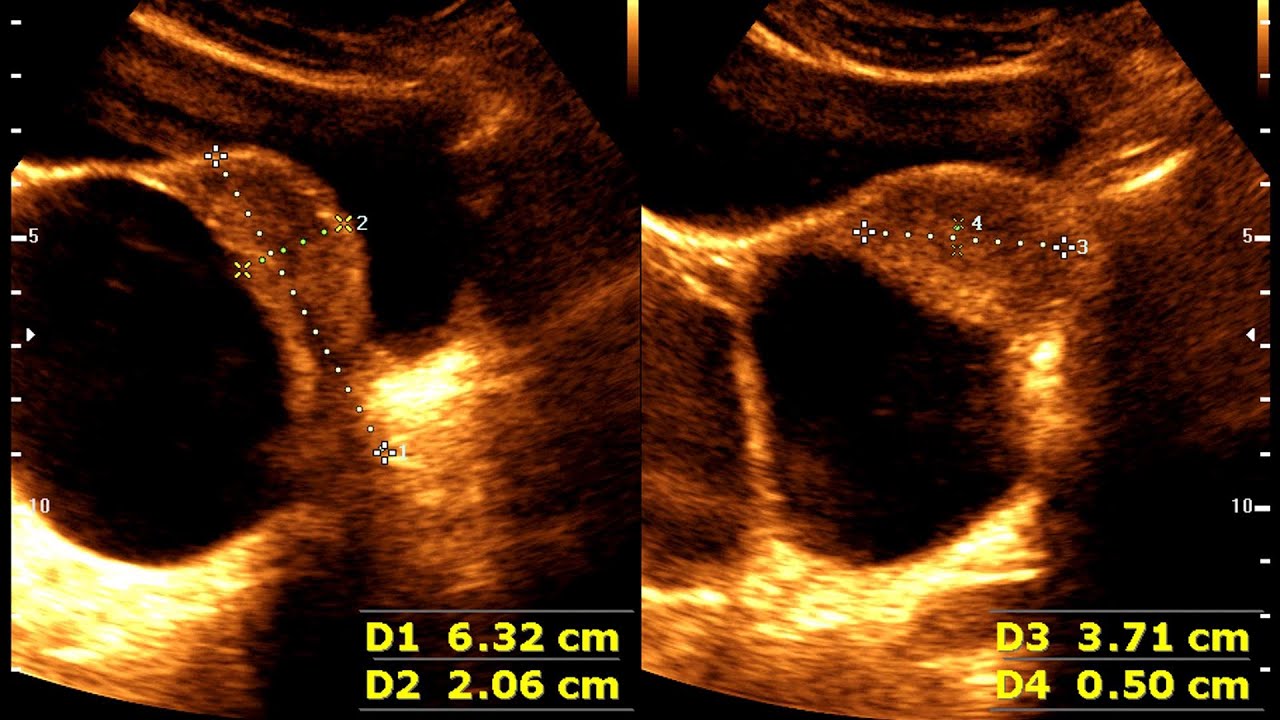 Bilateral Ovarian cyst || Cases 515 of 2000 - YouTube