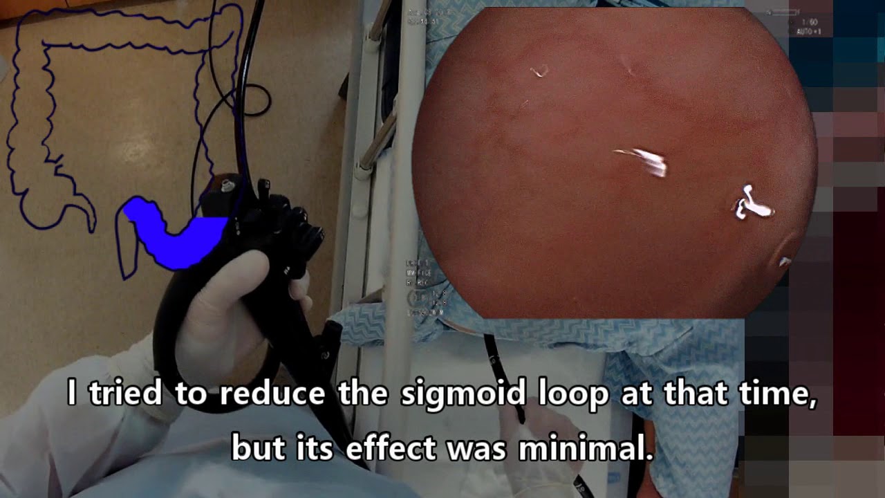 022.Reducing the sigmod loop and passing into the A-colon - YouTube