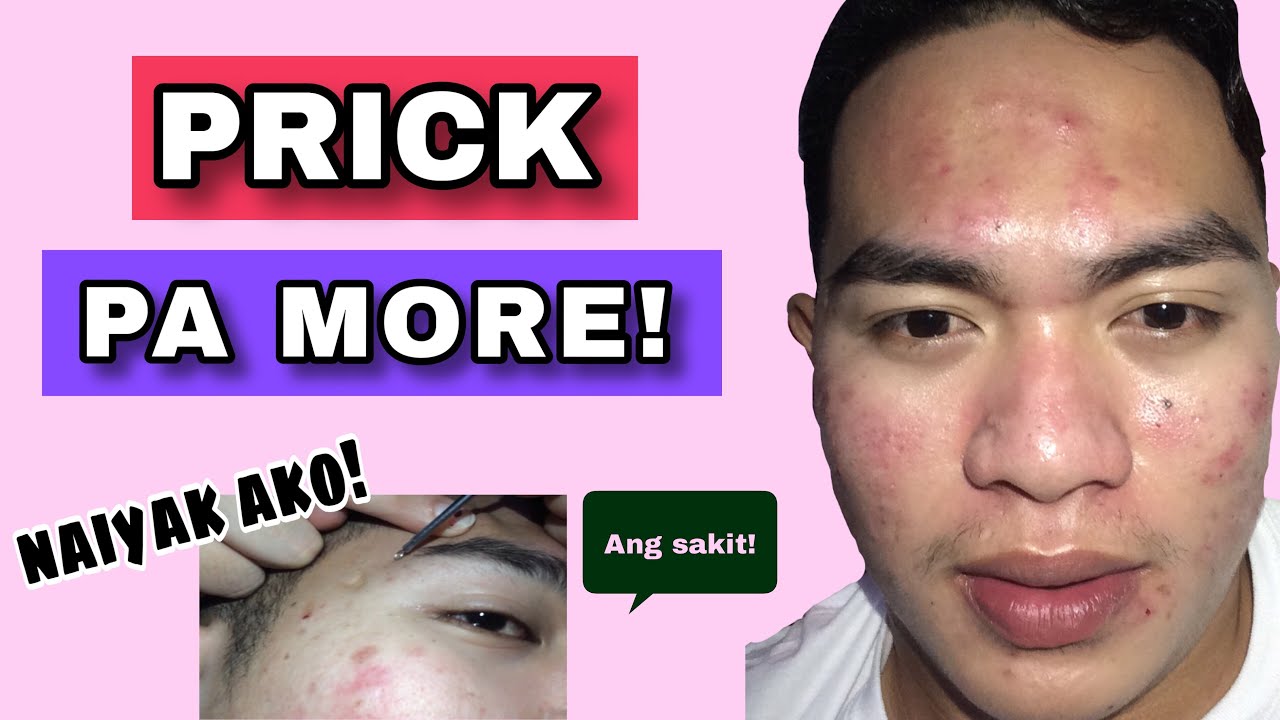 NAGPA PRICK/FACIAL AKO! NAMAGA! Ang sakit!😭 Blackhead Pimple Facial ...