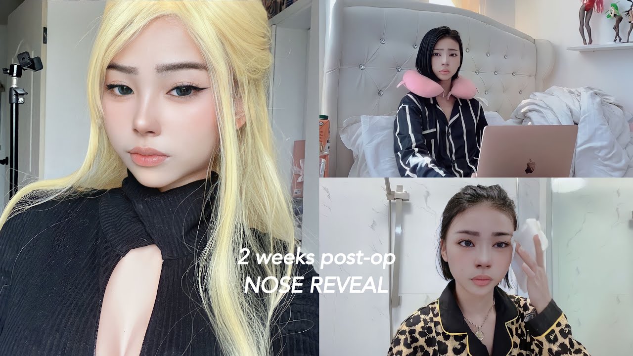 MY RHINOPLASTY JOURNEY | Q&A + NOSE JOB REVEAL - YouTube