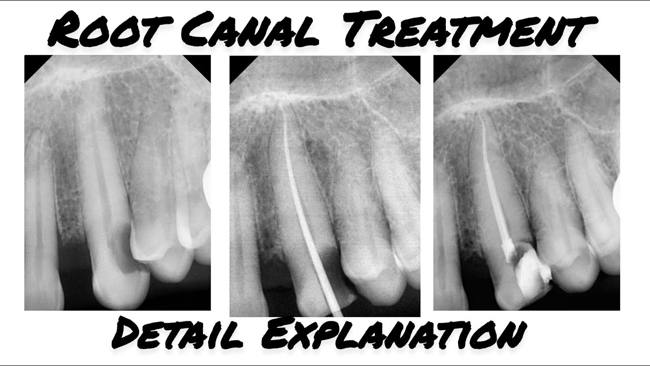 Root Canal Treatment on live Patient (23 Canine) | Single Seating RCT ...