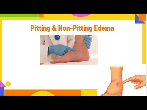 pitting & non-pitting edema || edema types and causes || edema ...
