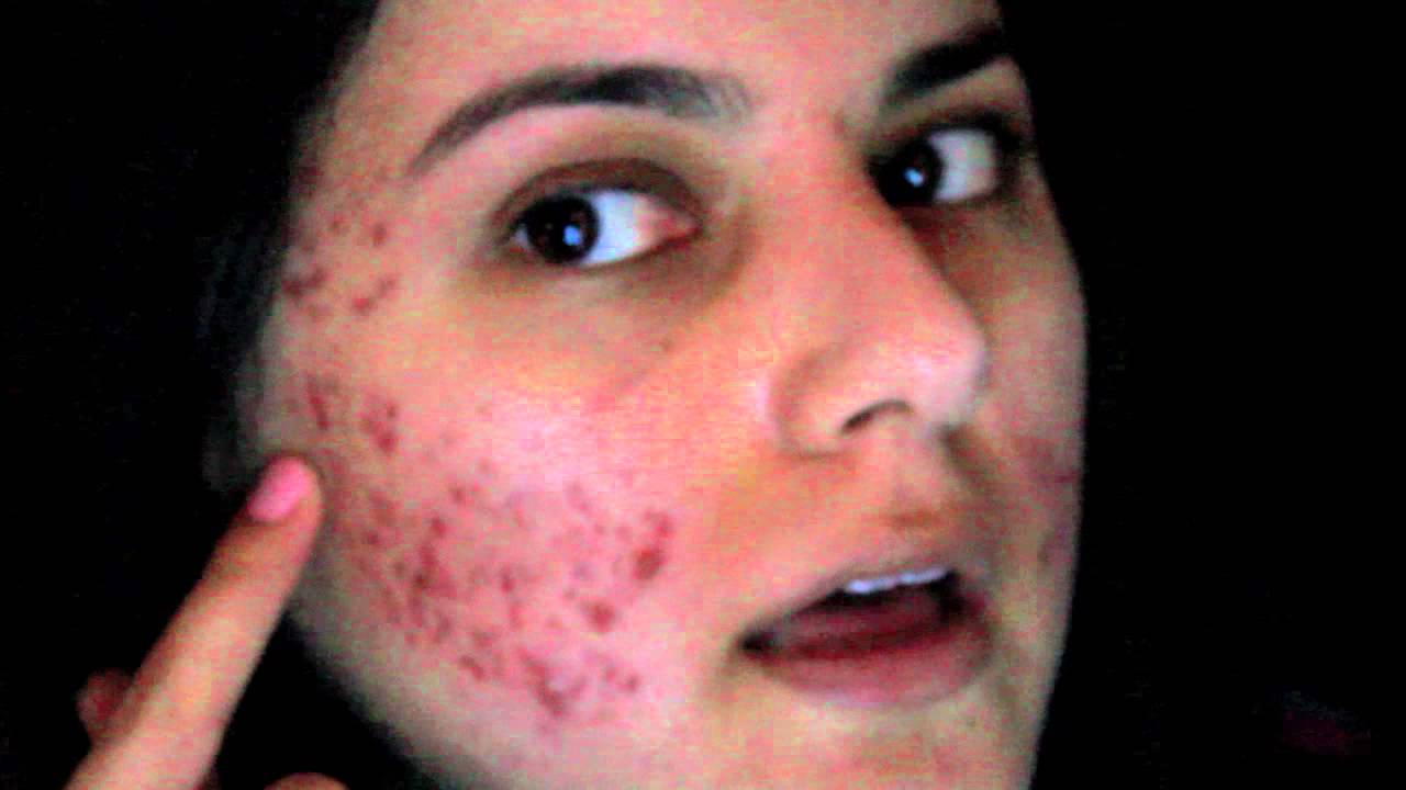 Skin Update/Acne Struggles | Amy Ali - YouTube