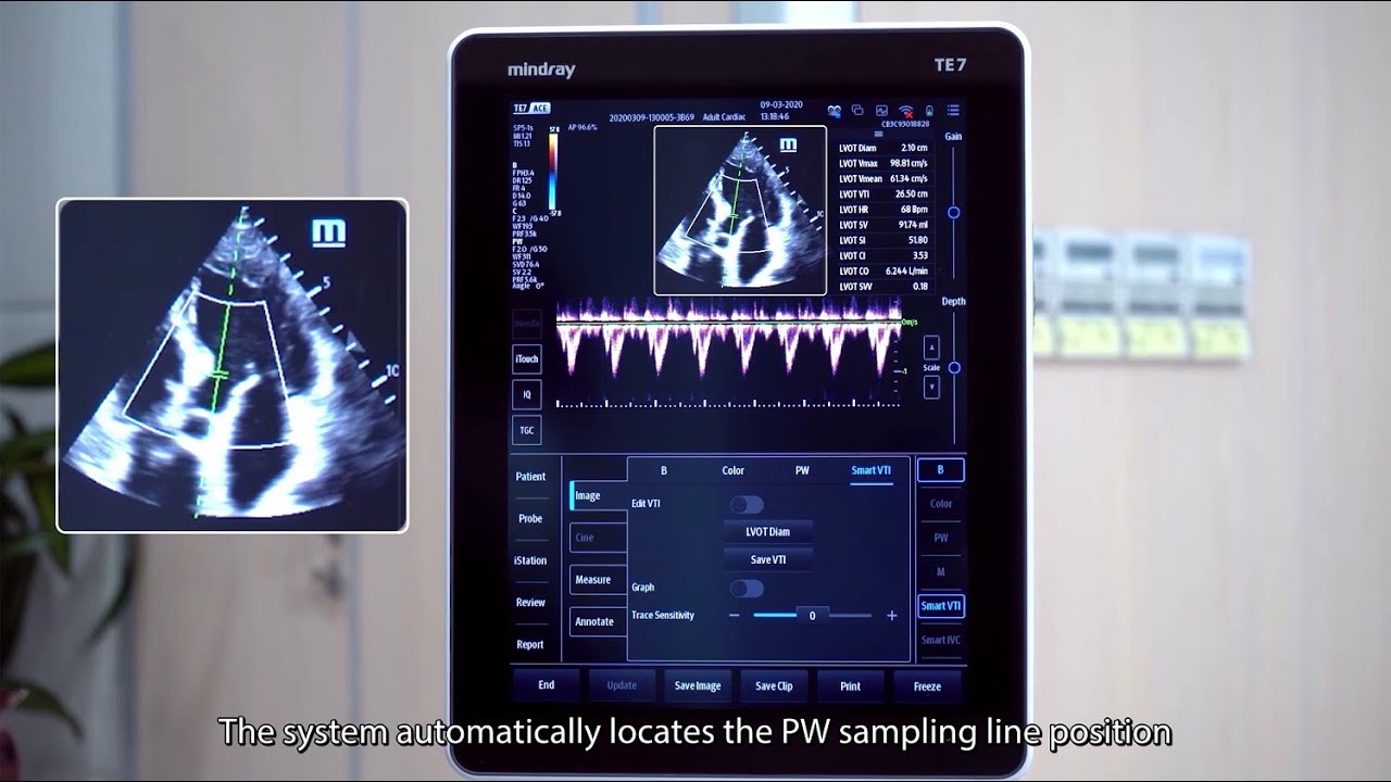 Mindray TE7 ACE- Smart VTI Demo Video - YouTube