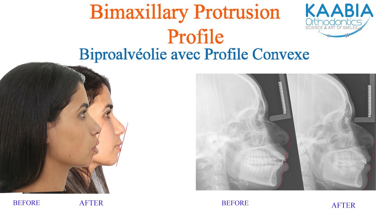 Témoignage traitement Biproalvéolie avec profile convexe/testimony ...