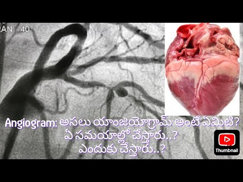 కరోనరీ యాంజియోగ్రామ్ ఎందుకు చేస్తారు?Coronary angiogram(Cardio vascular ...