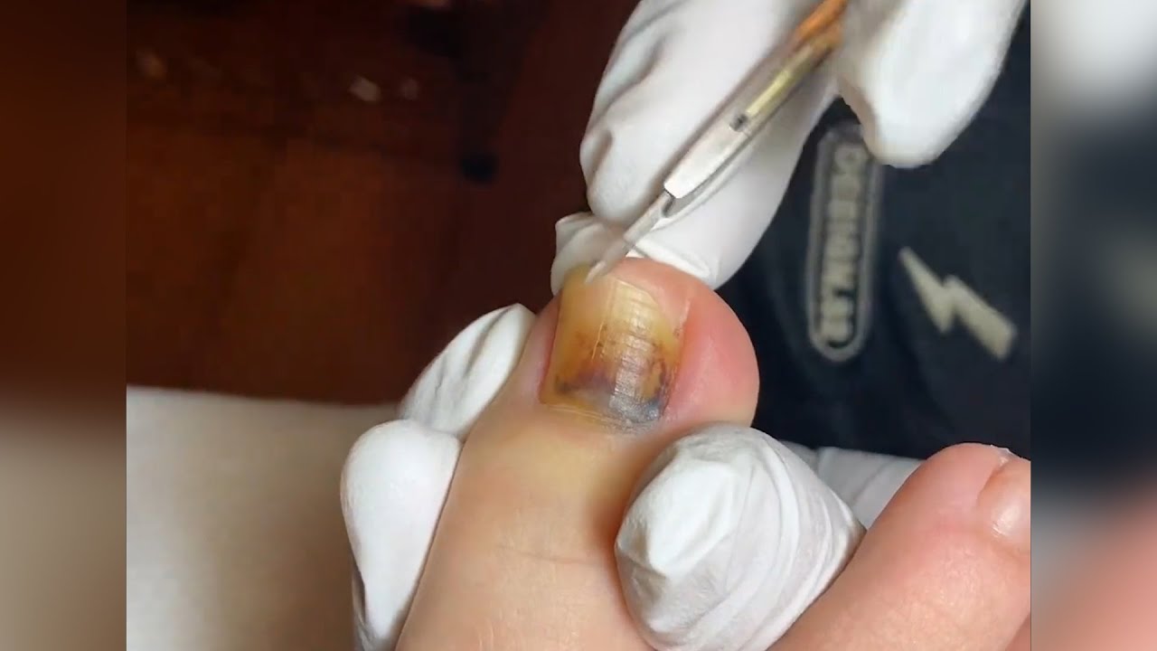 Pedicurist removes ingrown nails for black onychomycosis.【修腳師傅liu dr ...
