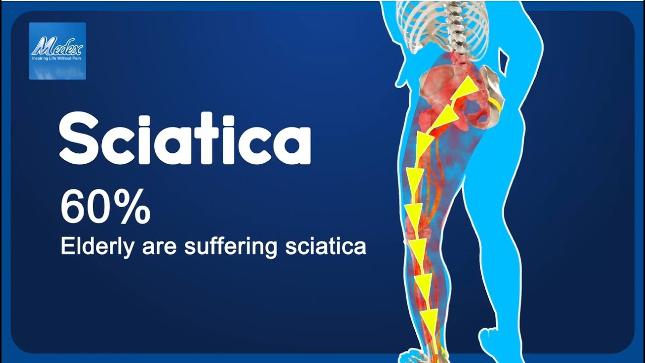 Understanding Sciatica: Causes, Treatment Options, and Innovative Solutions | medexbrace - YouTube