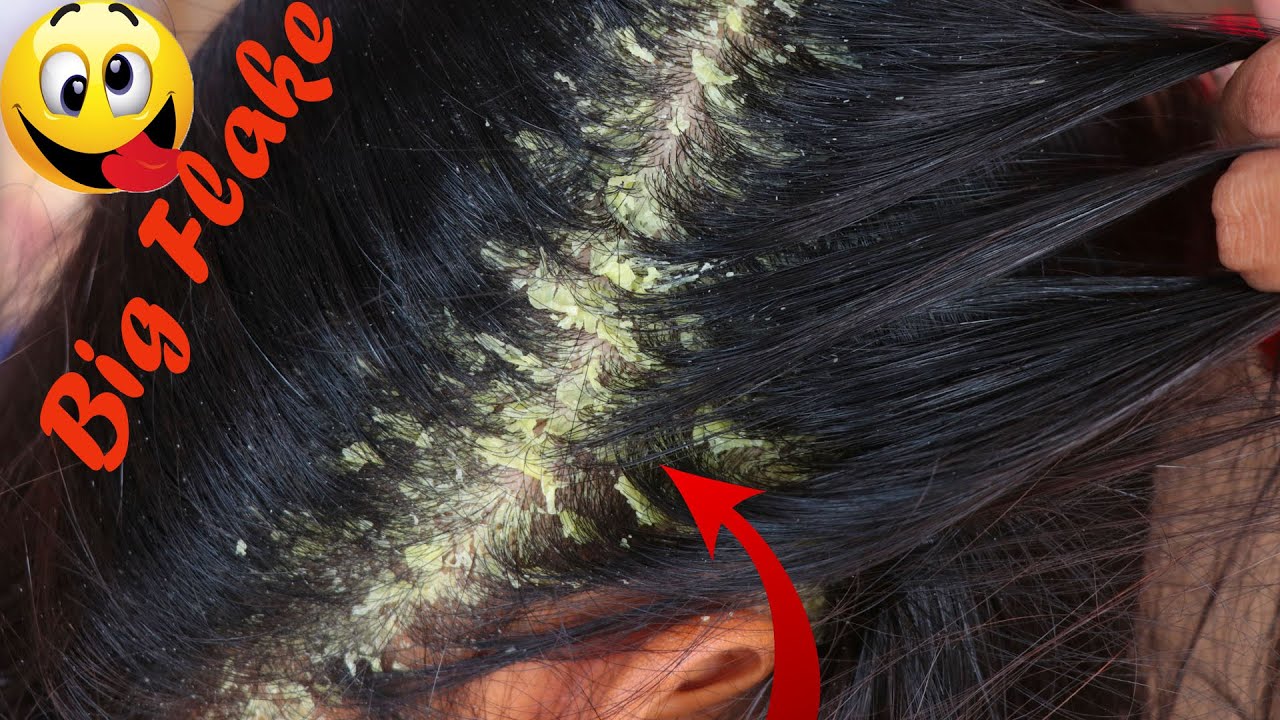 Dandruff Flakes Microscope