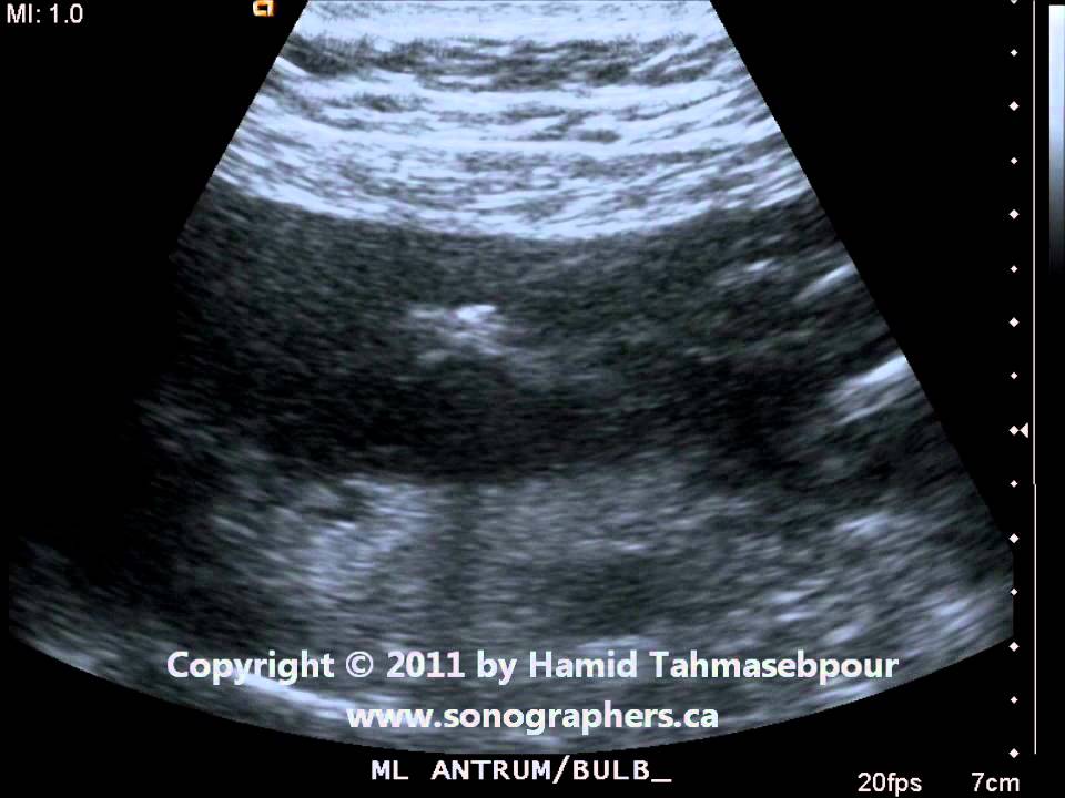 Duodenal Ulcer - YouTube