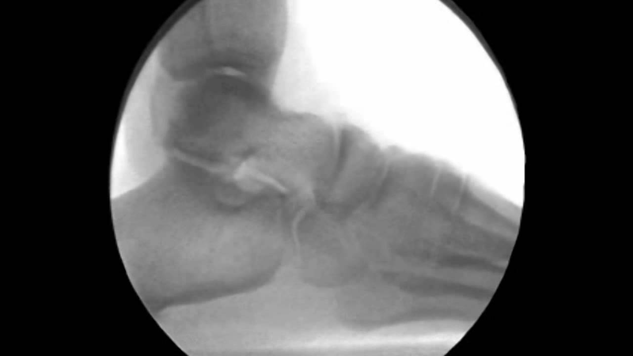 Talotarsal Joint - Normal - YouTube