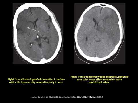 CNS imaging 2 - YouTube
