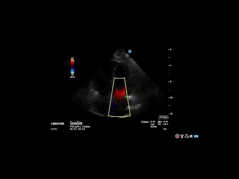 What Is Gradient In Echocardiography