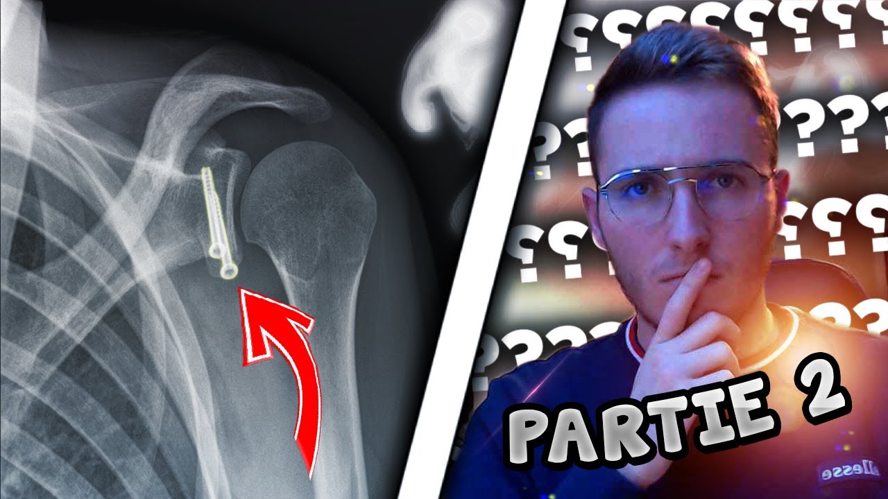 Mon opération de l'épaule | Butée d'épaule (Partie 2/2) - YouTube