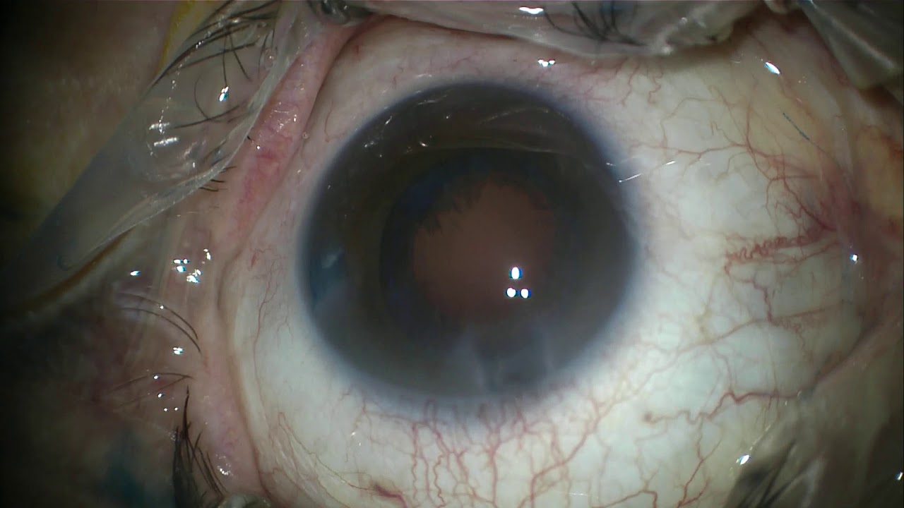 Intumescent Cataract - YouTube