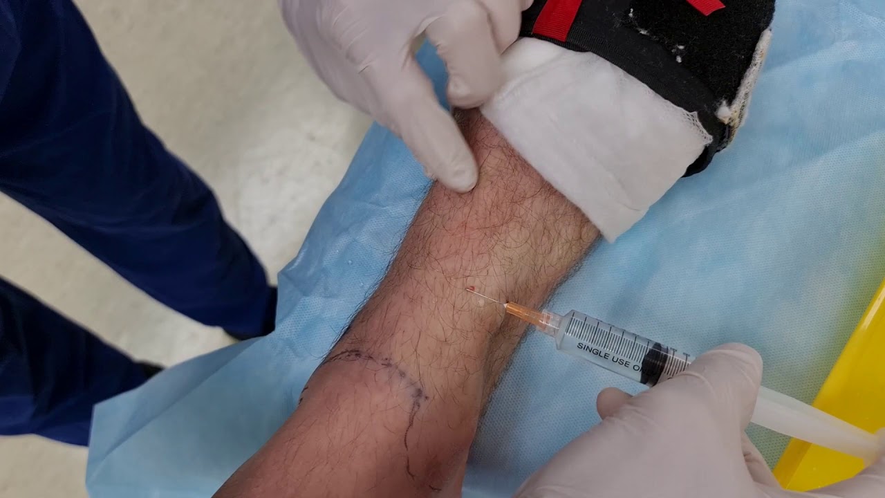 How to Perform an Ankle Block - YouTube