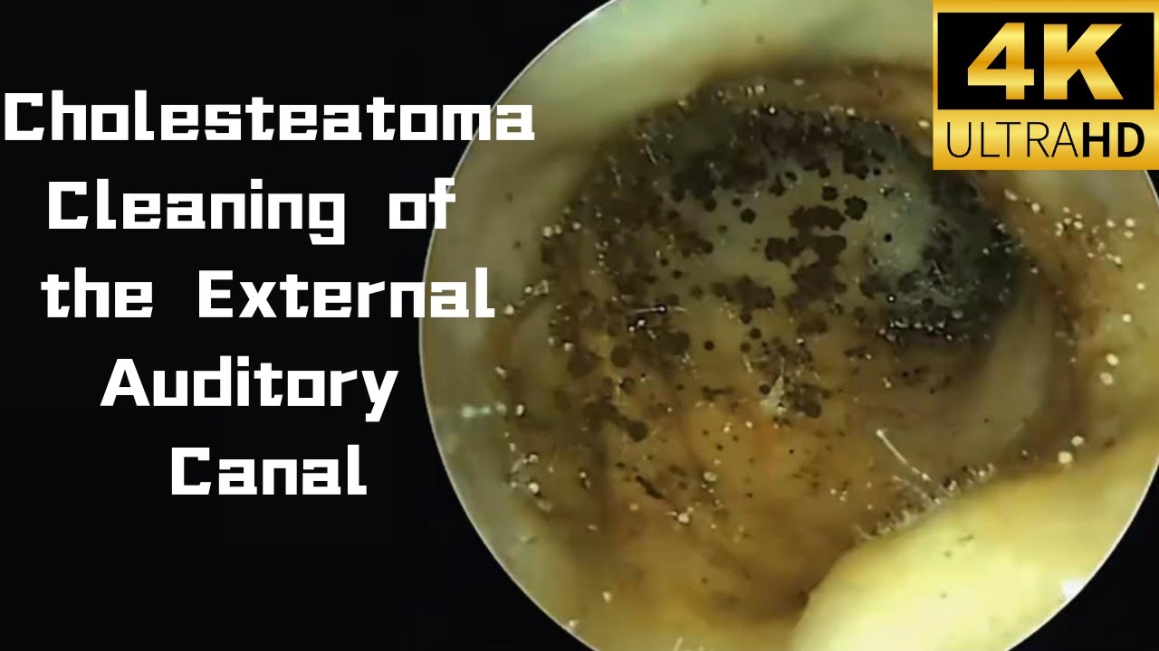 Cholesteatoma Cleaning of the External Auditory Canal |ear wax removal ...