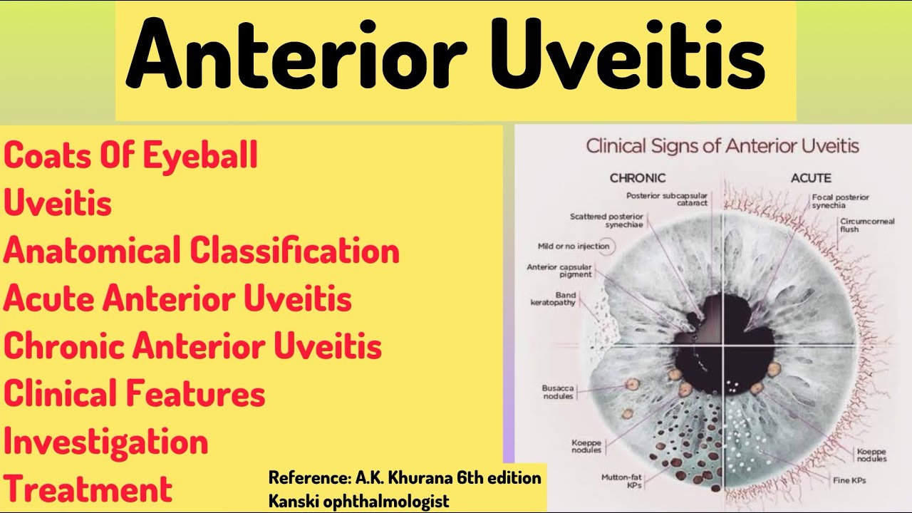 Anterior Uveitis | AK Khurana 6th edition| #optometrist #eyespecialist ...