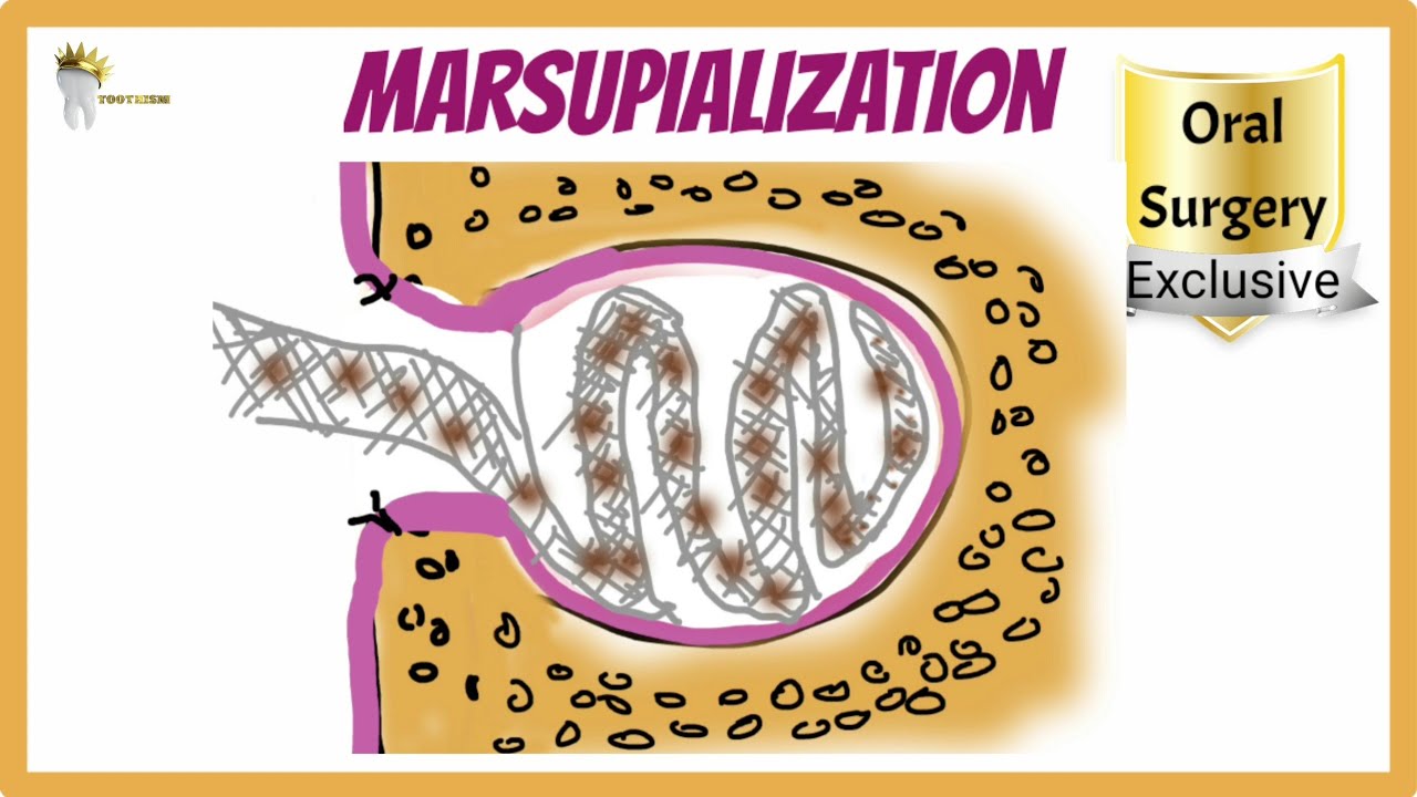 Marsupialization