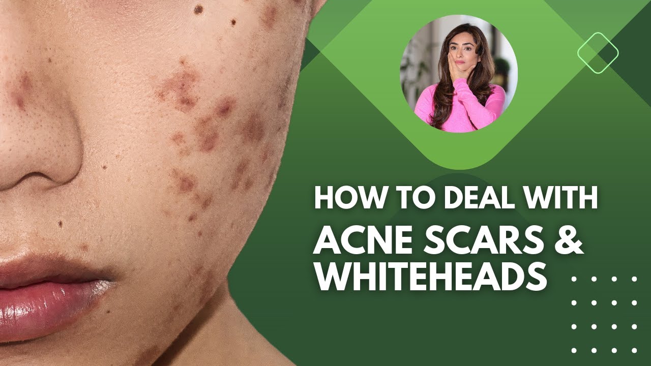 Reduce Acne Marks I Whitehead Marks I Acne Scar Remedies I #acne ...