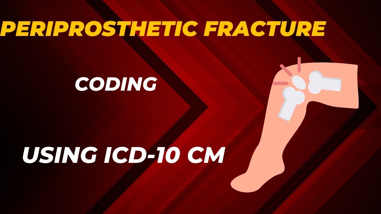 PERIPROSTHETIC FRACTURE CODING USING ICD-10 CM - YouTube
