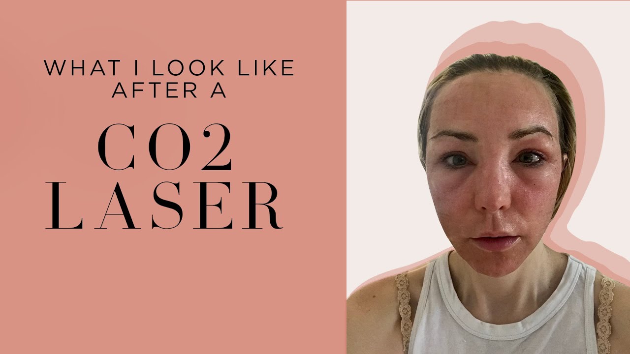 My CO2 Laser Experience: Post-Treatment Transformation and Recovery ...