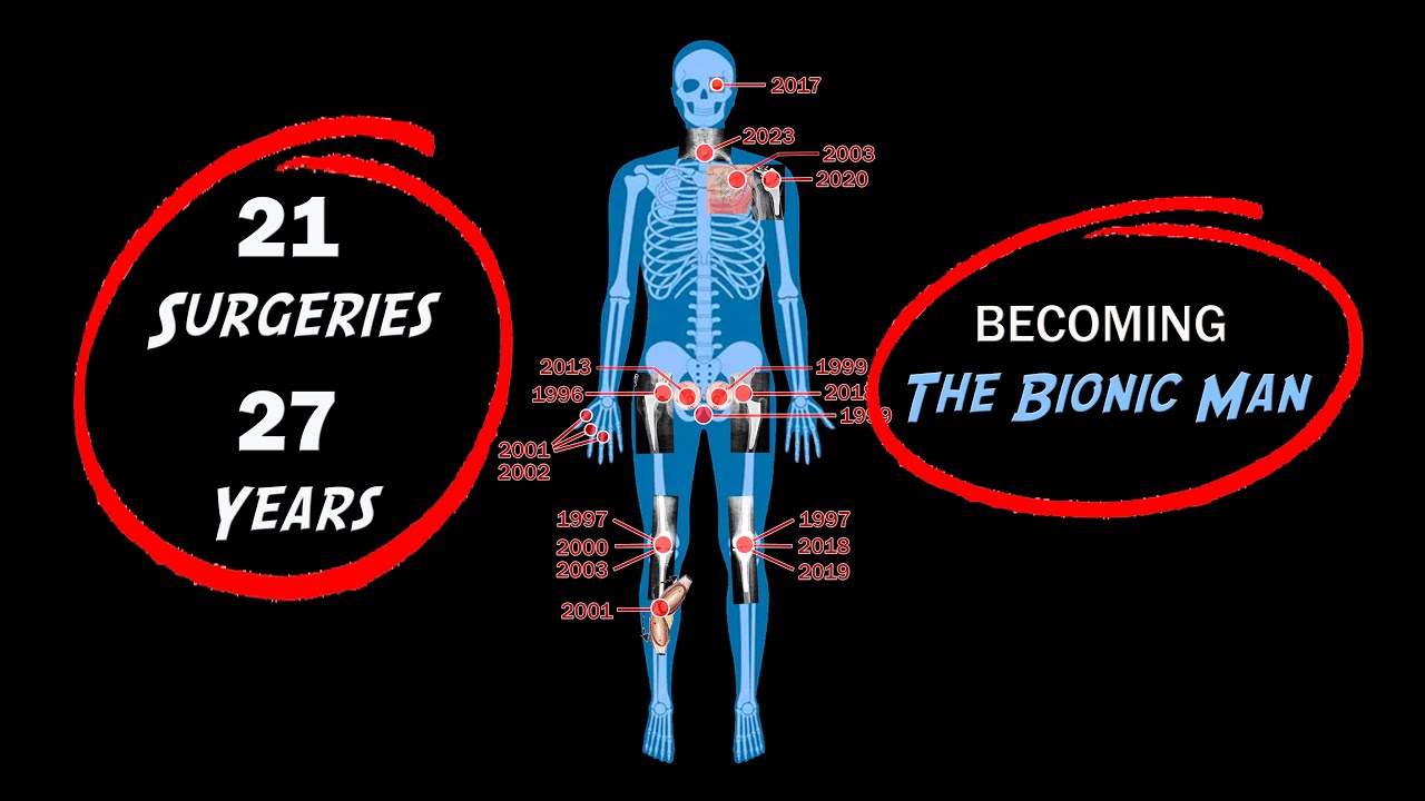 Becoming The Bionic Man - Episode 1 of the Handi Hacks with The Bionic Man - YouTube