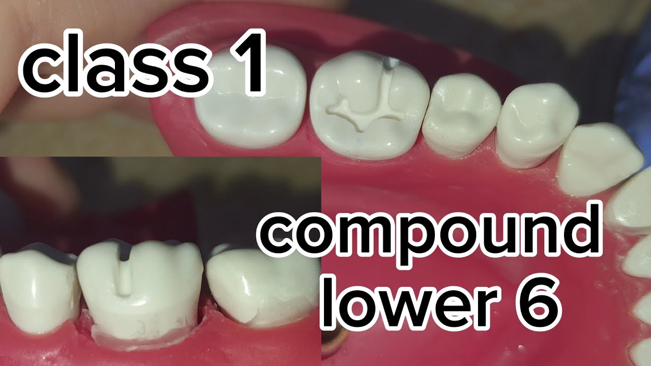 class 1 compound for lower 6 - with tips 💯- simplified - YouTube