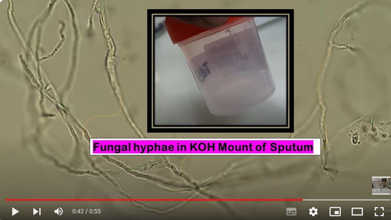 Fungal branched hyphae in KOH mount of Sputum Microscopy - YouTube