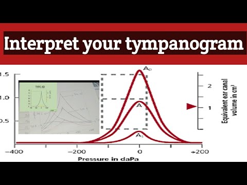 Tympanometry test | Tympanogram interpretation | how to read ...