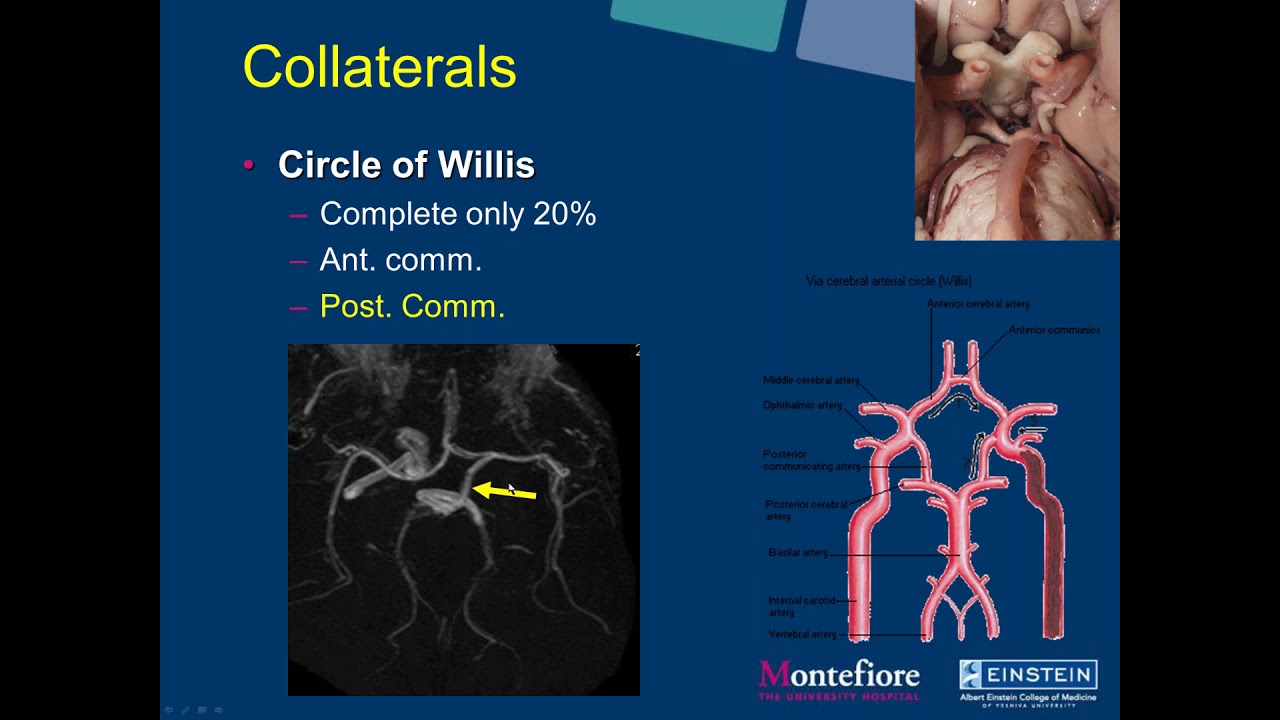 SIR-RFS Webinar (2/27/2018): Neuro Interventional Radiology: Carotid ...