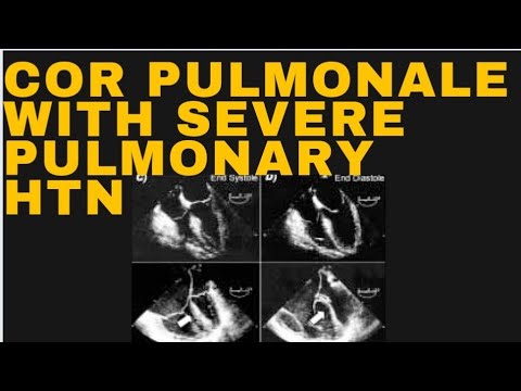 #Echocardiography. Cor pulmonale with severe pulmonary hypertension ...