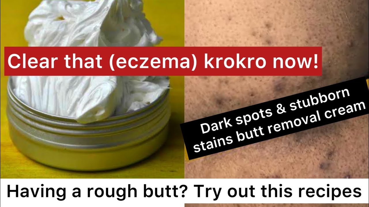Clear away butt rash( krokro) spots, eczema on your butt in less than a ...
