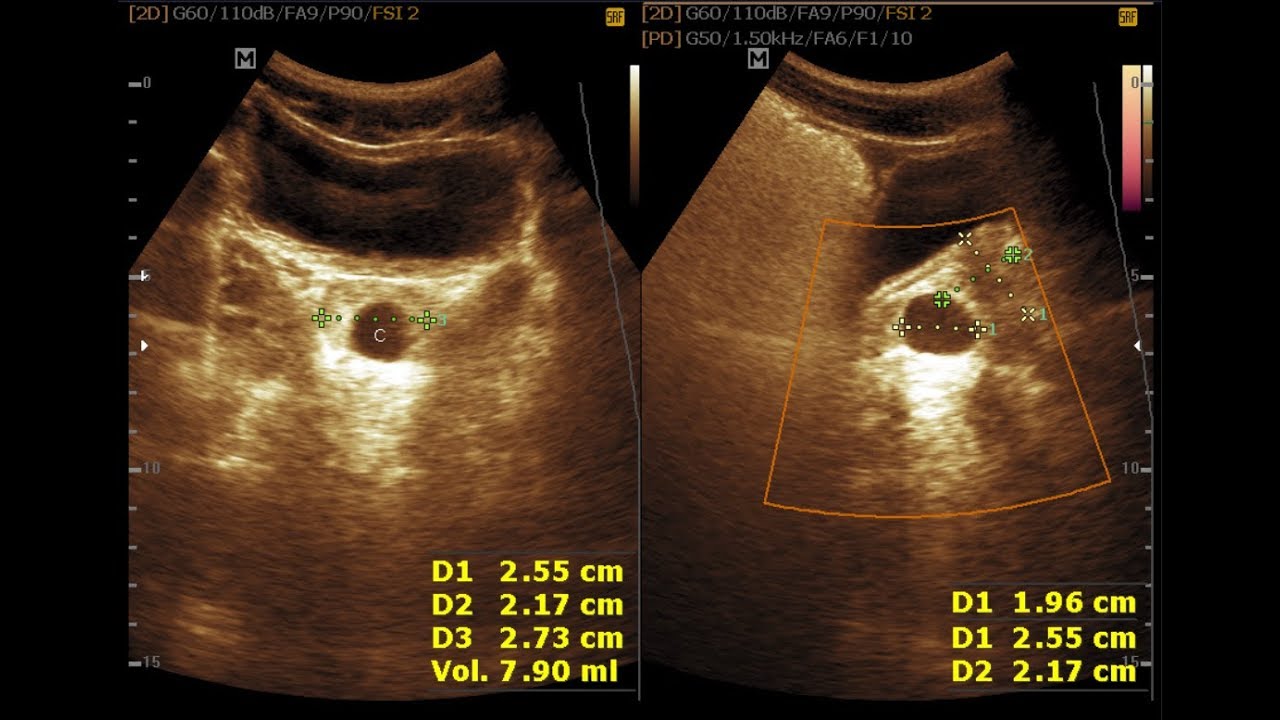 Right seminal vesicle cyst - YouTube