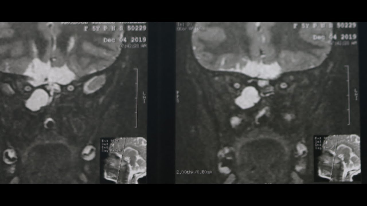 ORBITAL APEX MUCOCELE أصعب حالات فقد البصر بسبب تجمع مخاطى حول العصب ...