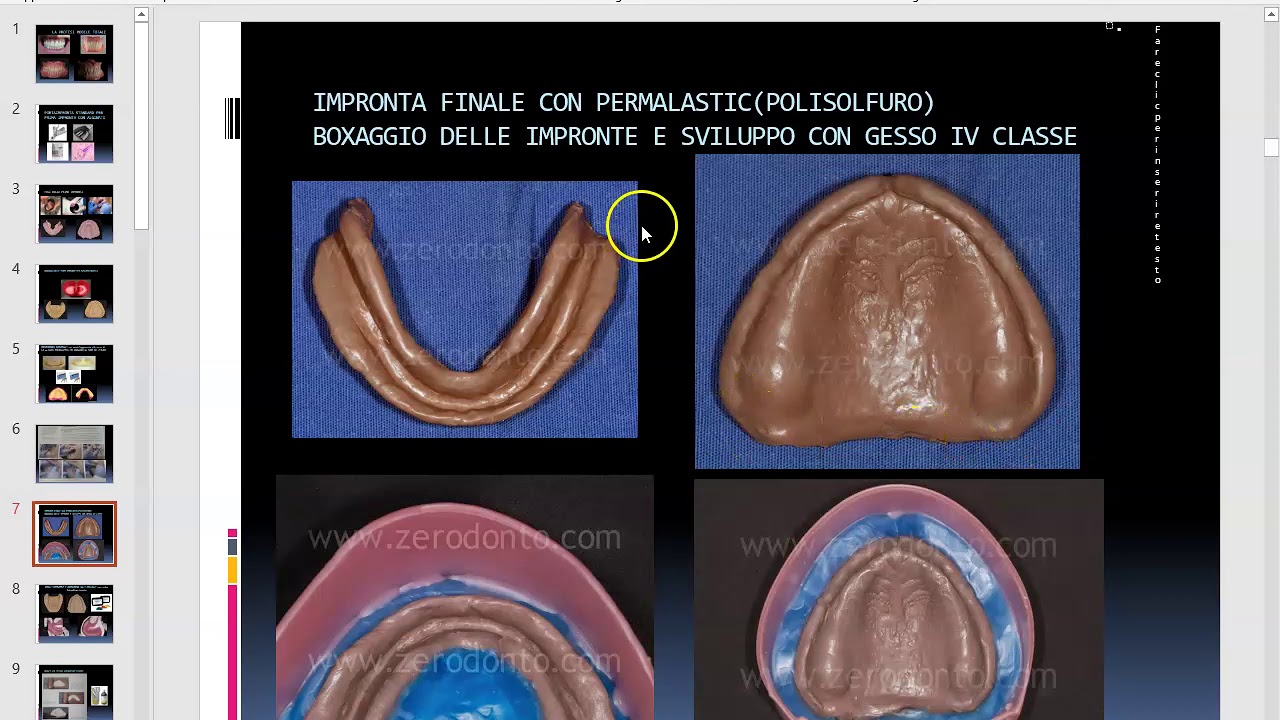 Protesi mobile totale 1^ fase - YouTube