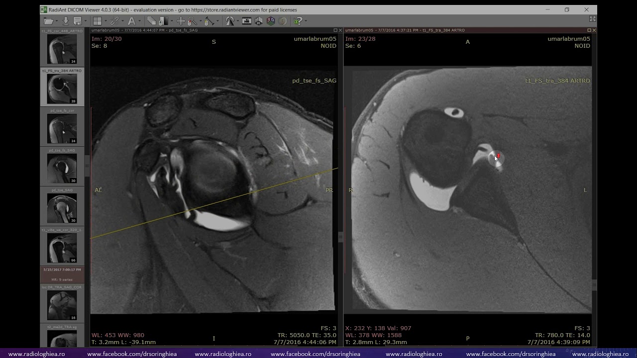 Caz umăr labrum 05 explicat - YouTube