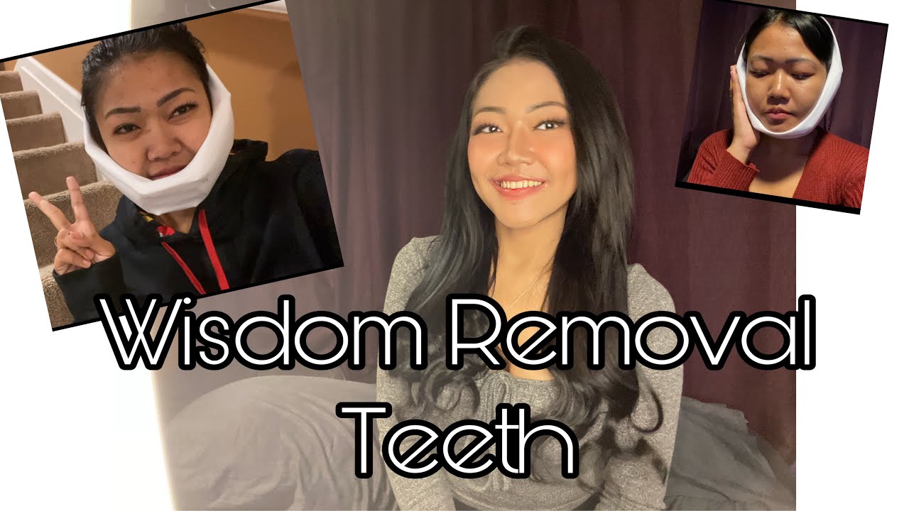 Wisdom Removal Teeth Story | How to survive after removal wisdom teeth ...