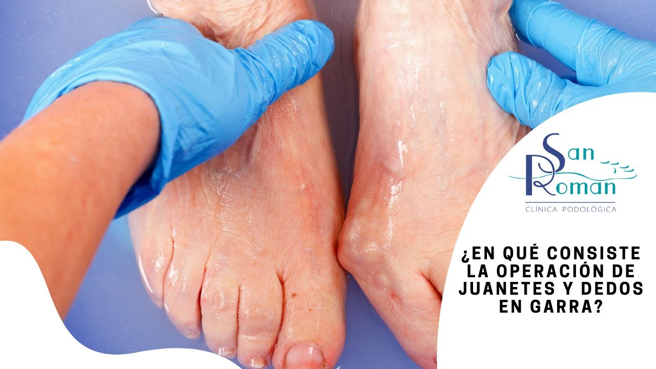 ¿En qué consiste la operación de juanetes y dedos en garra? - 👣 Clínica ...