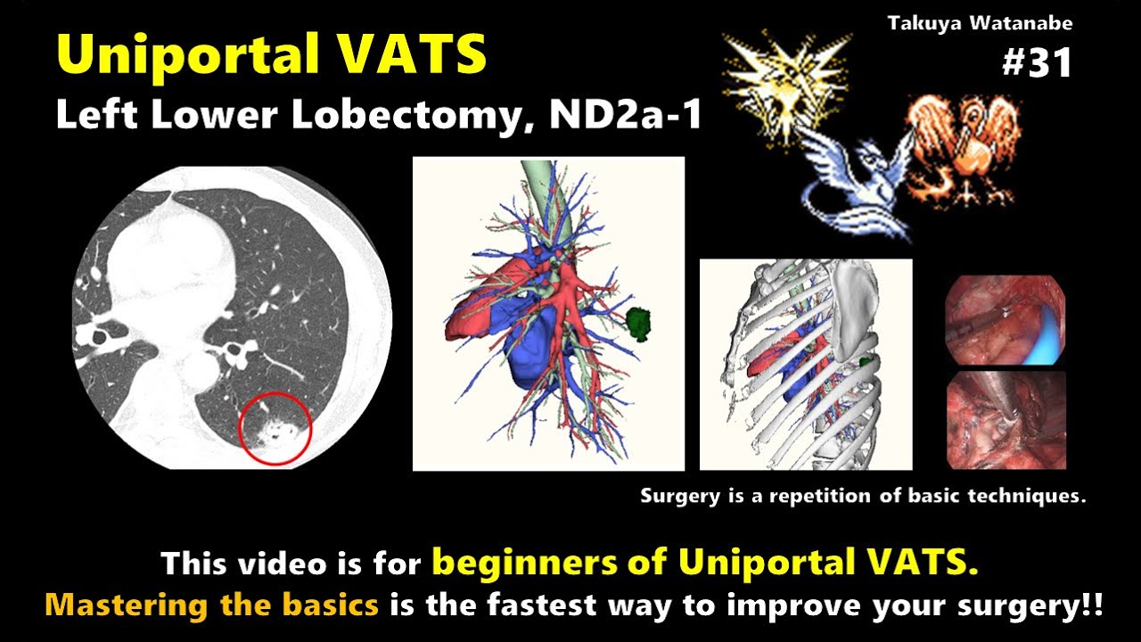 No.31 Uniportal VATS Left Lower Lobectomy, ND 2a-1 (Basic Case ...