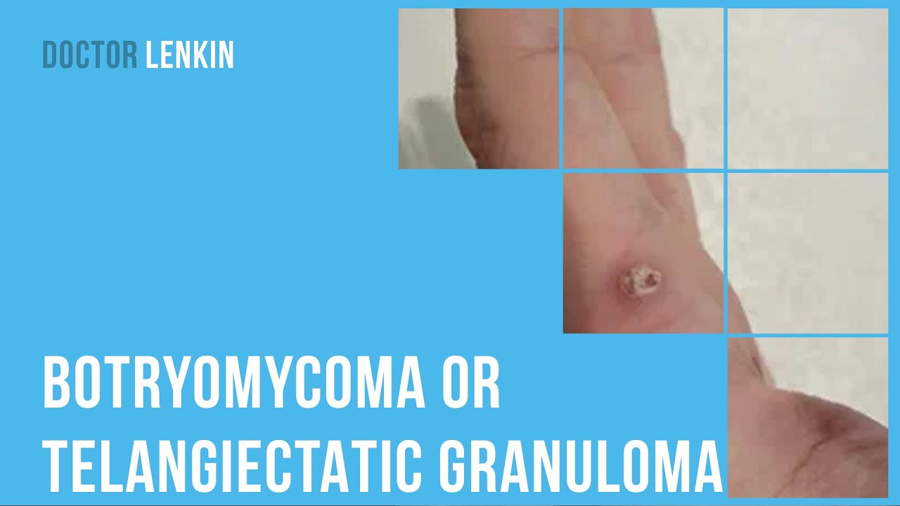 🖐 Botryomycoma or telangiectatic granuloma in the hand region - YouTube