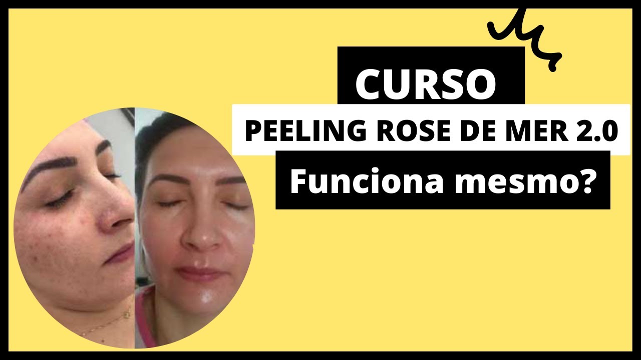 Curso Peeling Rose Mer 2. 0 Monica Hirsch- Curso Peeling Rose Mer 2.0 ...