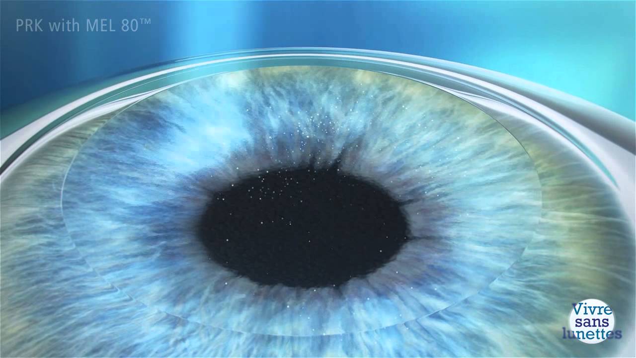 PRK- Opération des yeux par Laser - YouTube