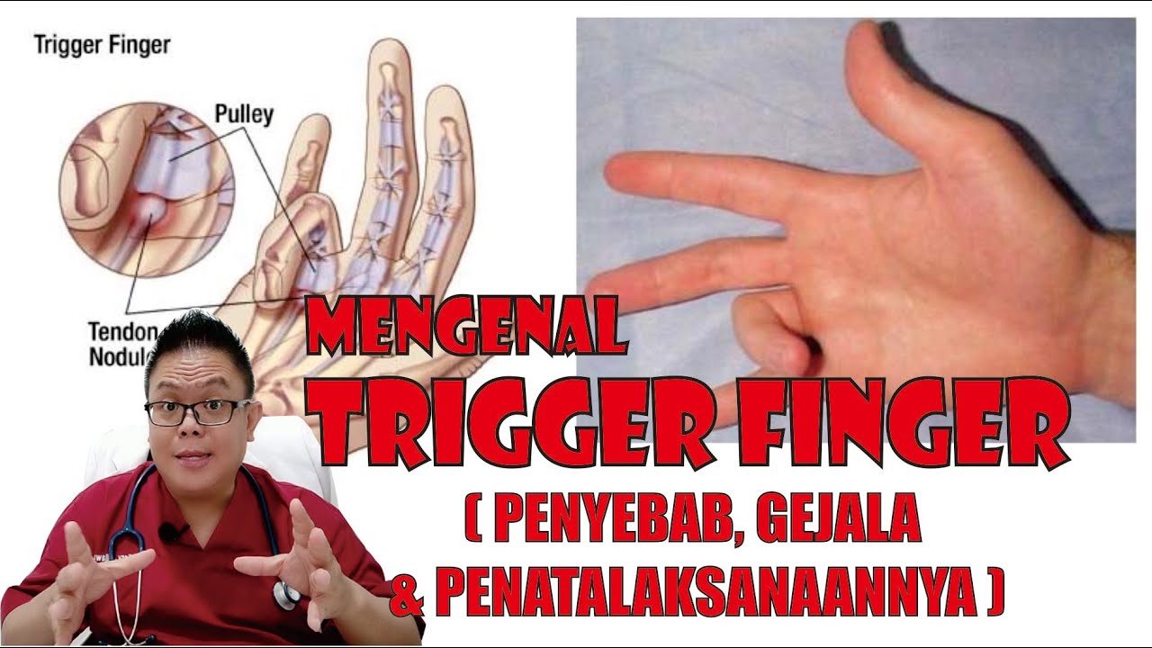 TRIGGER FINGER............. PENYEBAB, GEJALA DAN PENATALAKSANAANYA ...