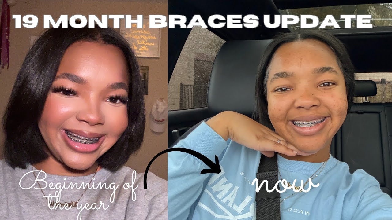 19-Month Braces Update //Am I getting my braces off today?? | shae ...