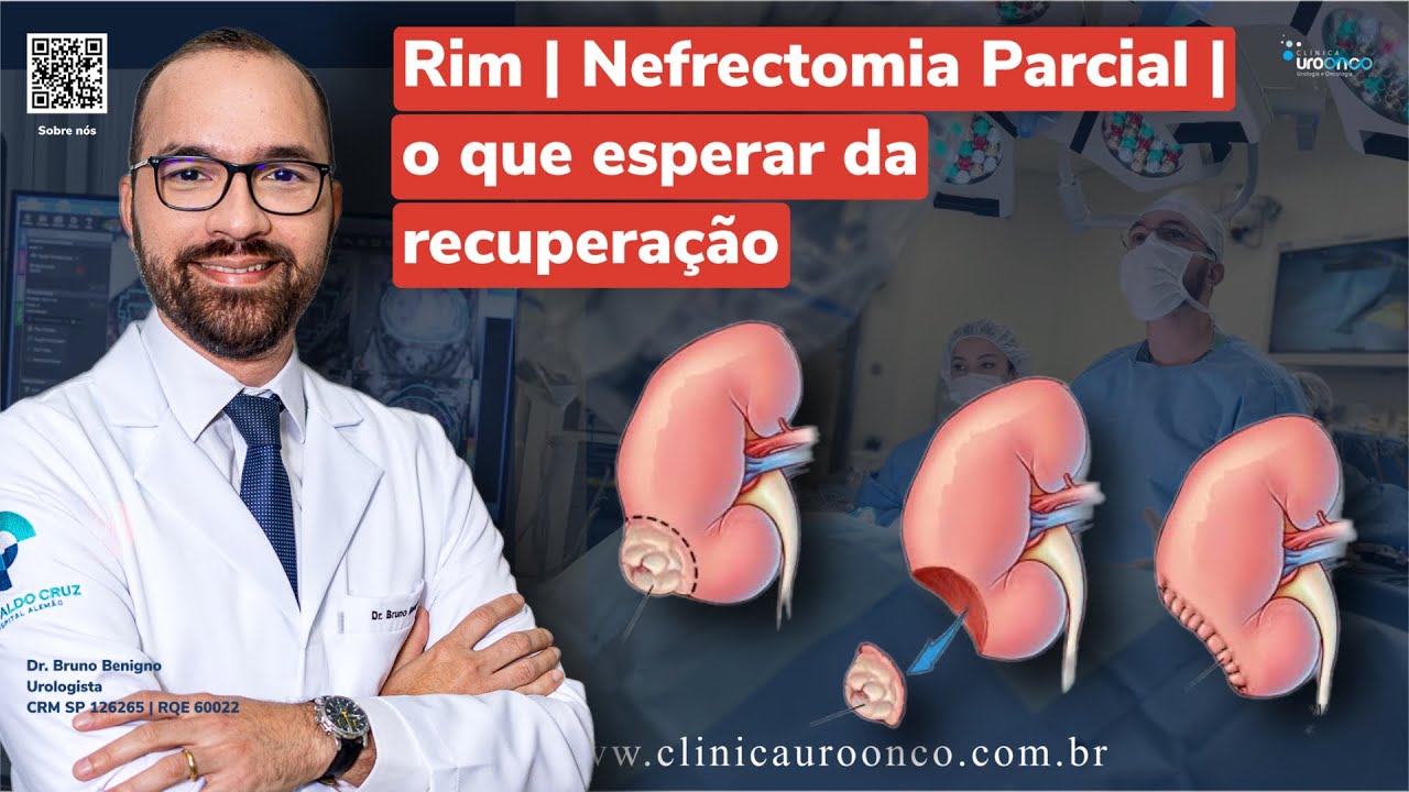 Nefrectomia Parcial | Cirurgia parcial Robótica do rim: O que Esperar ...