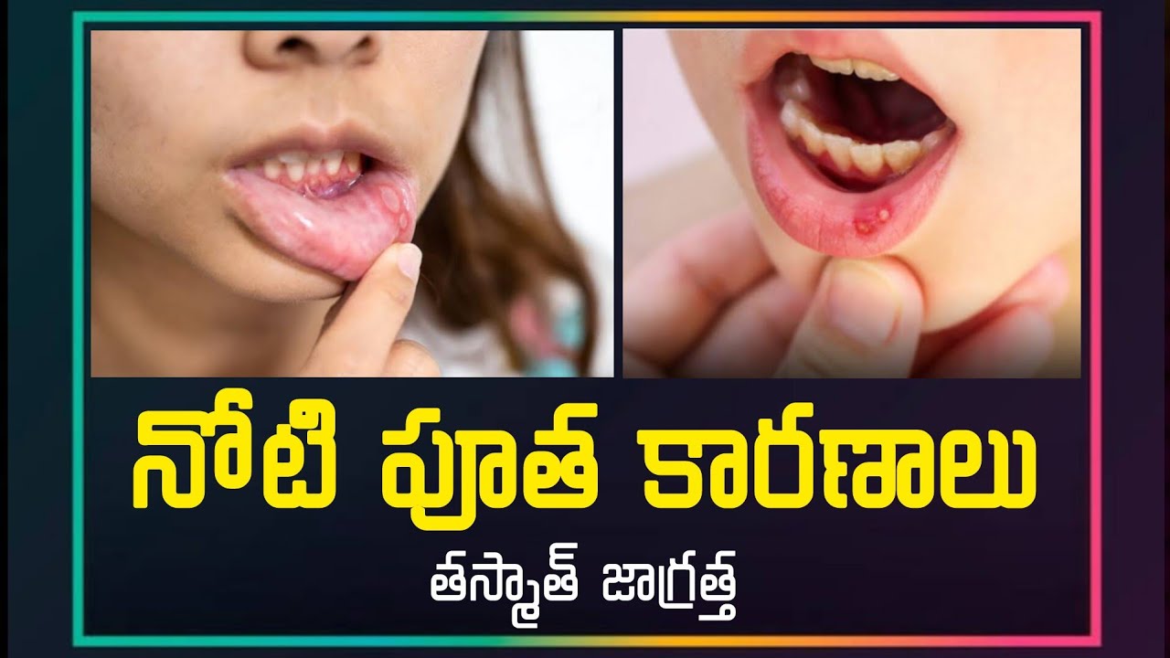 నోటి పూత కారణాలు తస్మాత్ జాగ్రత్త | Tooth Infection | Noti Putha ...